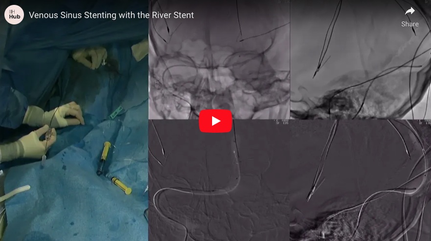 Venous sinus stenting with the River stent - IIH Hub