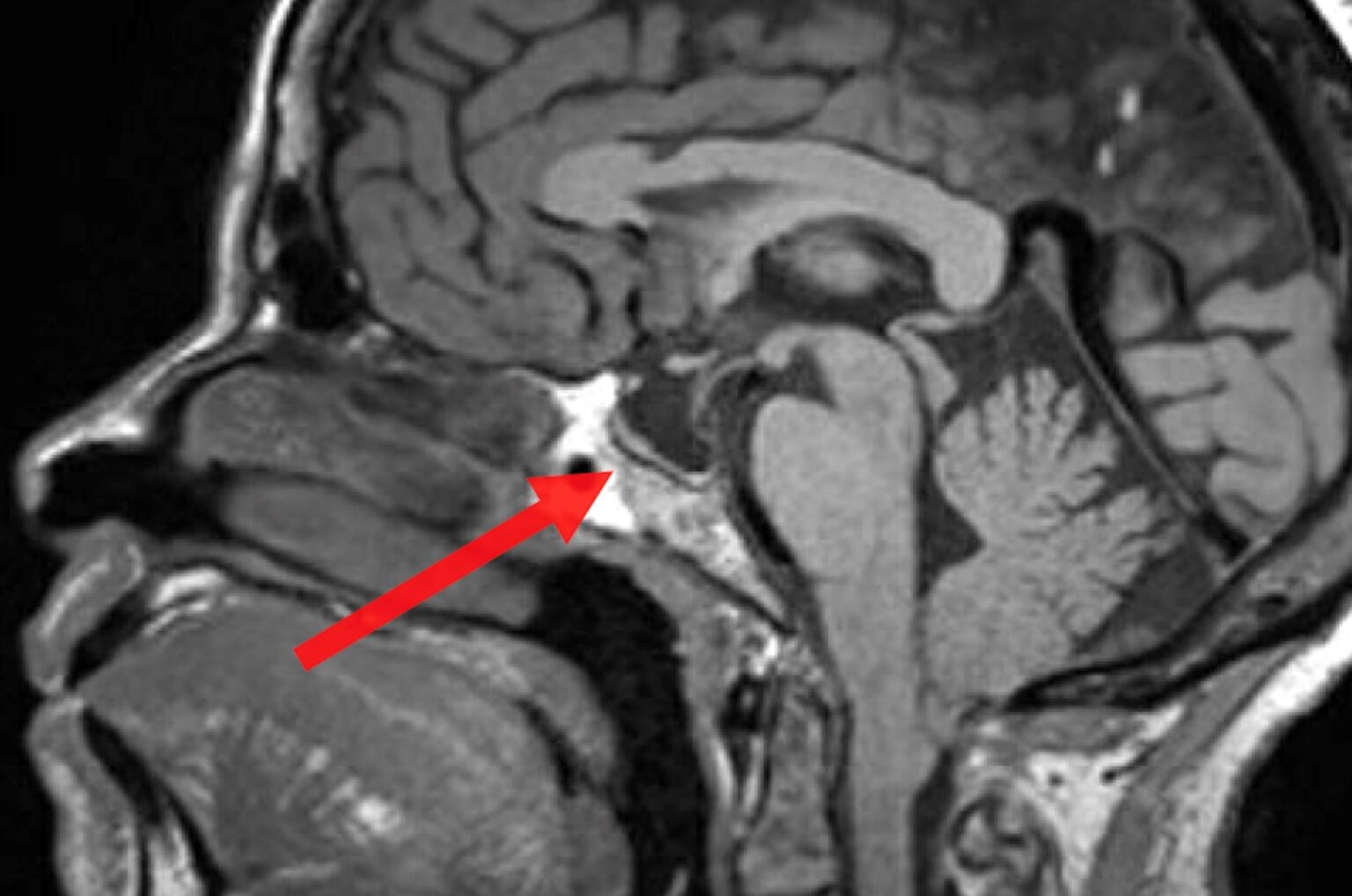Venous Sinus Stenosis and it's role in IIH - IIH Hub