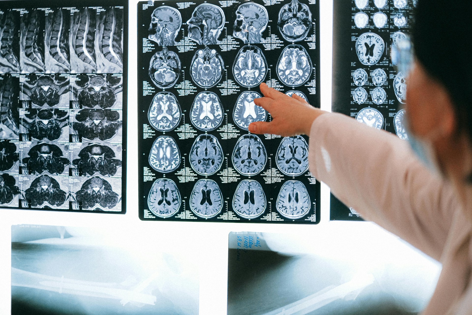 Shunt Procedures in the Management of Idiopathic Intracranial ...